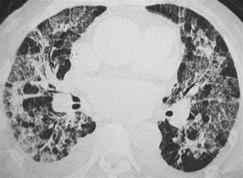 High Resolution Ct And Pathologic Findings Of Noninfectious Pulmonary