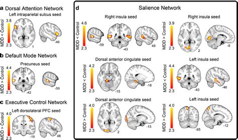 Group Differences In Resting State Connectivity In A The Dorsal Download Scientific Diagram