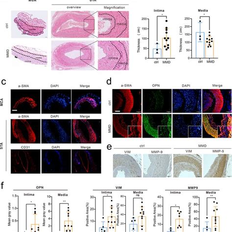 Vsmcs Exhibit Phenotype Switch In The Intima Of Mmd Vessels A