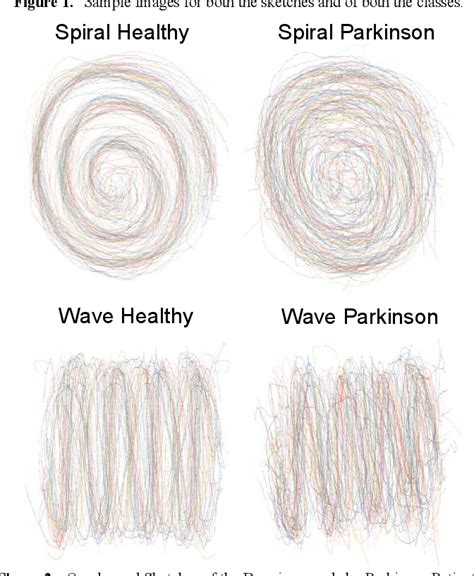 Figure 2 From Parkinsons Disease Detection From Spiral And Wave Drawings Using Convolutional