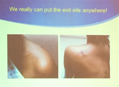 Insider Tips For PICC Patients From PICC Nurses Mighty Well Journal