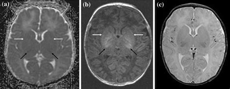 Pseudonormalization Of ADC On Day 4 Of Life A ADC Map Shows Download Scientific Diagram