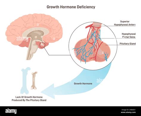 Growth Hormone Deficiency Syndrome Characterized By Insufficient