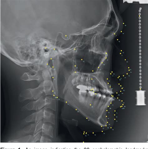 Figure 1 From Automated Identification Of Cephalometric Landmarks Part 1 Comparisons Between