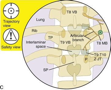 Thoracic Zygapophysial Joint Nerve Medial Branch Injection Posterior