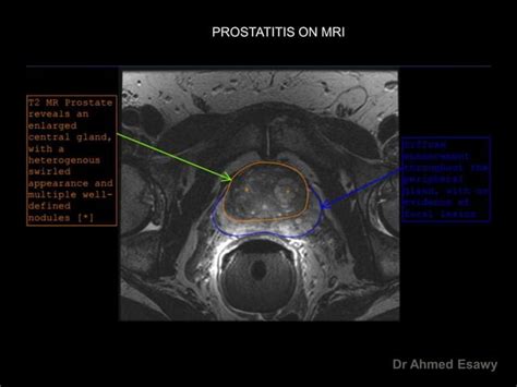 Imaging Prostatitis Urethritis Dr Ahmed Esawy Pdf