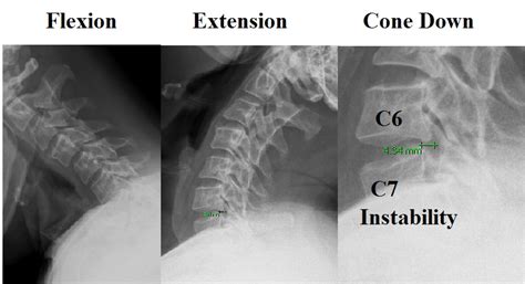 Cervical Instability Shimspine