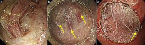 Endoscopic Devices With Water Jet Function A Endoscopes Equipped Download Scientific Diagram
