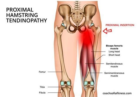 Hamstring Tendonitis Artofit