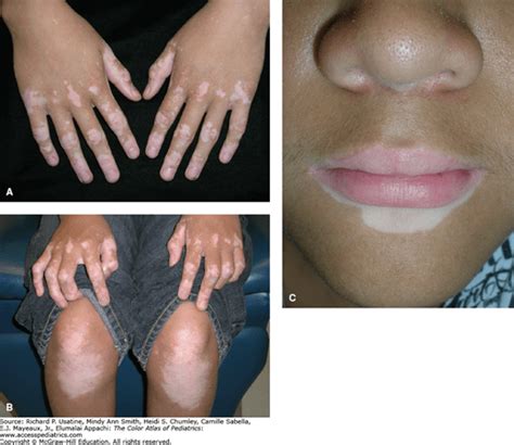 Vitiligo And Hypopigmentation Obgyn Key