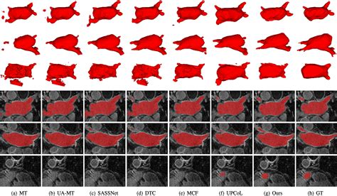 figure 3 from boundary aware prototype in semi supervised medical image segmentation semantic