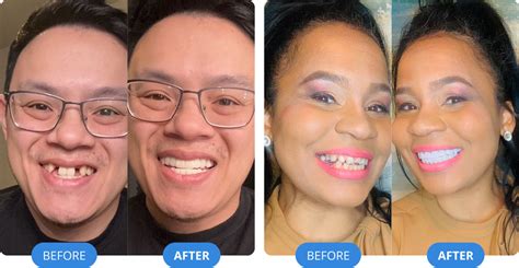 The Viral Clip On Secret Thats Giving Americans Perfect Teeth
