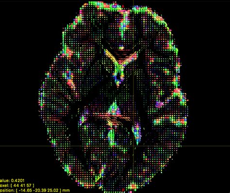 Multi Site Fixel Based Analysis 2 Step Population Template Creation Mrtrix3 Community