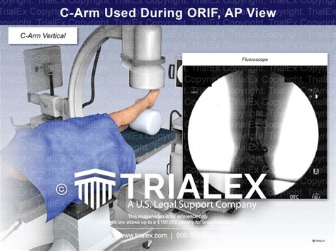 C Arm Used During Orif Ap View Trialquest Inc