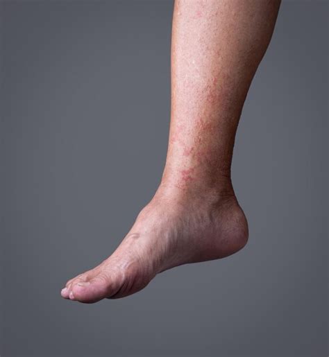 Premium Photo Strong Allergic Rashes On The Leg On Gray Background Dermatological Rash On The
