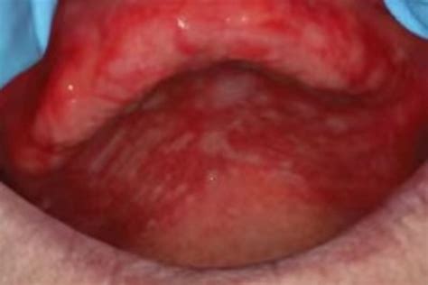 药物过敏性口炎白斑图片有来医生