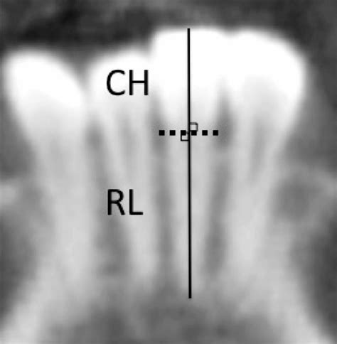 Tooth Size Measurements On Cbct Images Ch Indicates Crown Height Rl Download Scientific