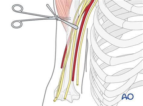 Hinged External Fixation Following Orif For Anterior Transolecranon Fracture Dislocation