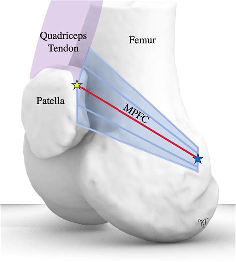 Quadriceps Tendon Repair Protocol