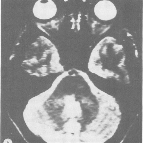 Pdf Fulminant Monophasic Multiple Sclerosis Marburgs Type