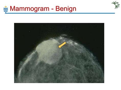 Breast Pathology Lecture 2013 Ppt