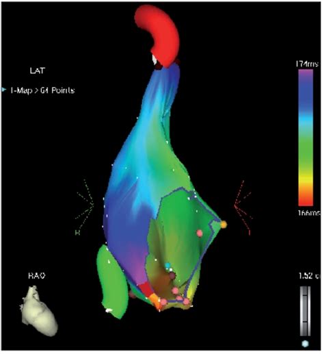 Electroanatomical Map Of Right Atrium Showing The Counterclockwise