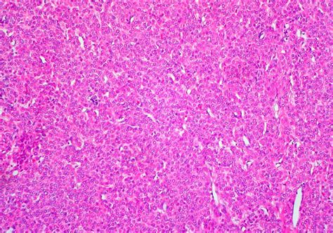 Epithelioid Leiomyoma Of Uterine Corpus