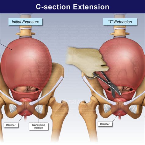 Medical Legal Exhibits Legal Animations And Trial Graphics