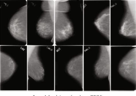 Figure 1 From Breast Cancer Classification From Mammogram Images Using