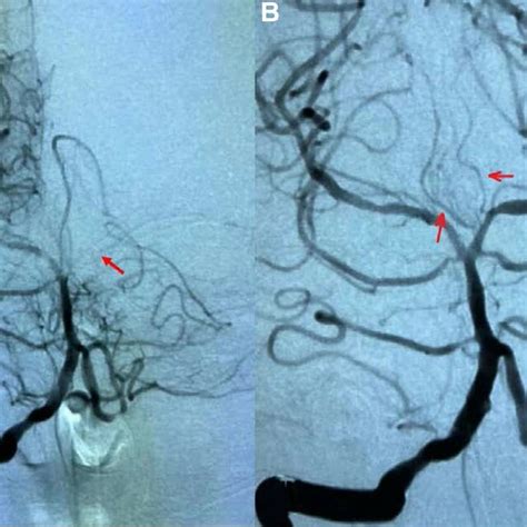Dwi Mra Imaging Of The Brain Illustrates A The Left Pca Is Not Download Scientific Diagram