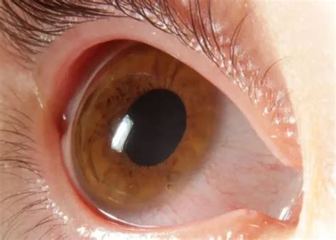 Treatments For Corneal And Scleral Disease At Sreedhareeyam