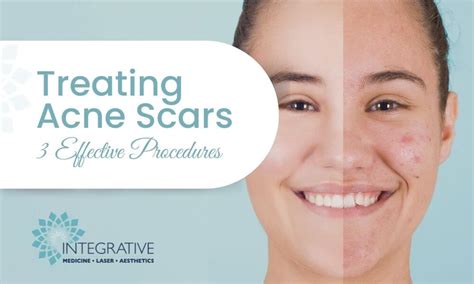 3 Effective Procedures For Treating Acne Scars Integrative Medicine Laser And Aesthetics
