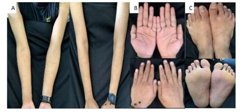 6 Th Month Dermatological Examination Multiple Well Defined