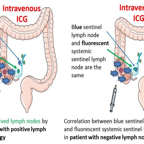 Illustrations Of The Systemic Sentinel Lymph Node Hypotheses In