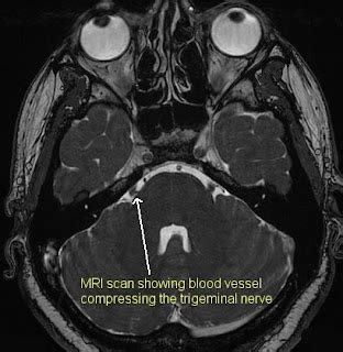Understanding Trigeminal Neuralgia