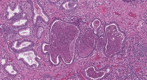 Benign Prostatic Hyperplasia Ottawa Atlas Of Pathology