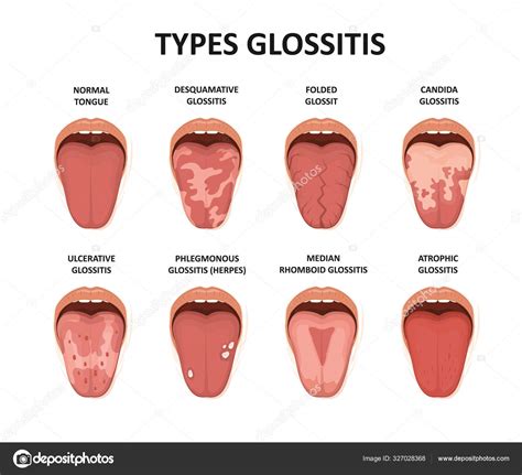 Types Glossitis Tongue Disease Illustration Stock Vector By