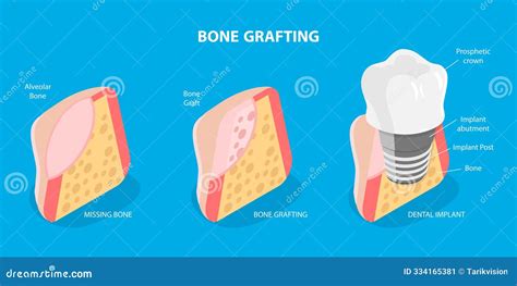 Understanding Bone Resorption The Crucial Role Of Osteoclasts In The