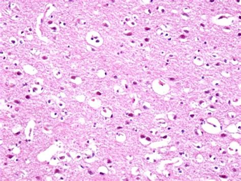 Brain Parenchyma With Spongy Aspect Resulting From The Death Of