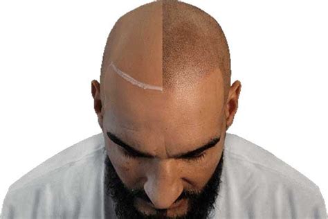 Scalp Micropigmentation Wa Beauty Clinic Scalp Micropigmentation Wa Beauty Clinic
