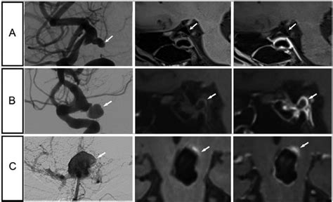 Qualitative And Quantitative Wall Enhancement On Mri Is Associated With