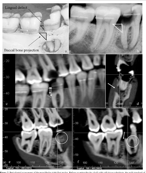 Figure 1 From Detection Of Periodontal Bone Loss Using Digital Intraoral And Cone Beam Computed