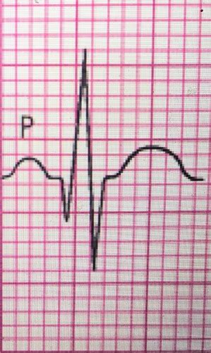 Ecg Waveforms Segments And Intervals Flashcards Quizlet