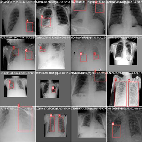 深度学习目标检测】二十二、基于深度学习的肺炎检测系统 含数据集、gui和源码（python，yolov8）speed 70ms Preprocess 1196ms Inference