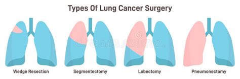 Wedge Resection Stock Illustrations 7 Wedge Resection Stock