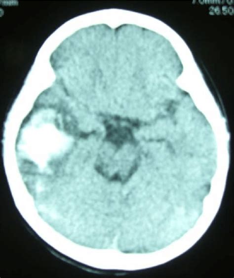 Brain Computed Tomographic Scan Showing Intracranial Hemorrhage