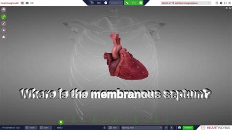 The Location Of The Membranous Septum Membranous Vsd Perimembranous Vsd Gerbode Defect Can