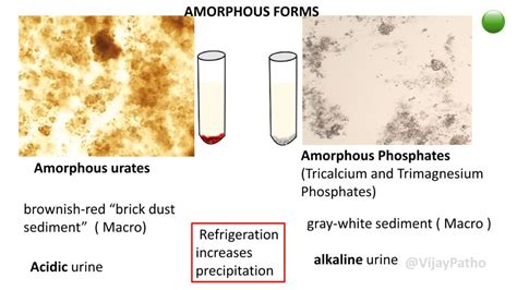Amorphous Urates In Urine