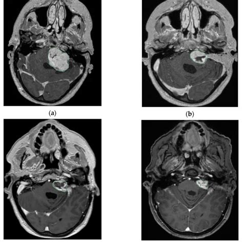 An Axial T1 Mris With Contrast For Left Vs Koos D Showing Tumor