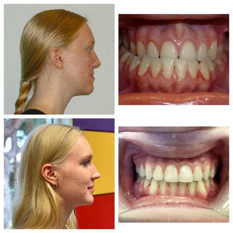 Underbite Treatment In Palm Beach Gardens Murray Orthodontics